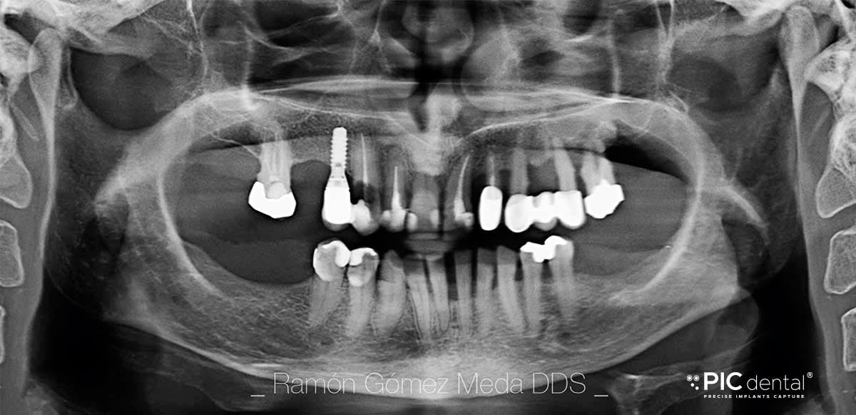 Rehabilitación de una enfermedad periodontal avanzada con una prótesis ...