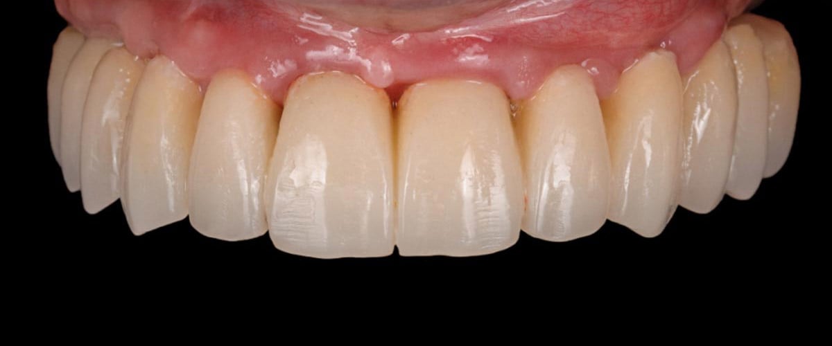 Rehabilitation of an advanced periodontal disease with a scalloped denture