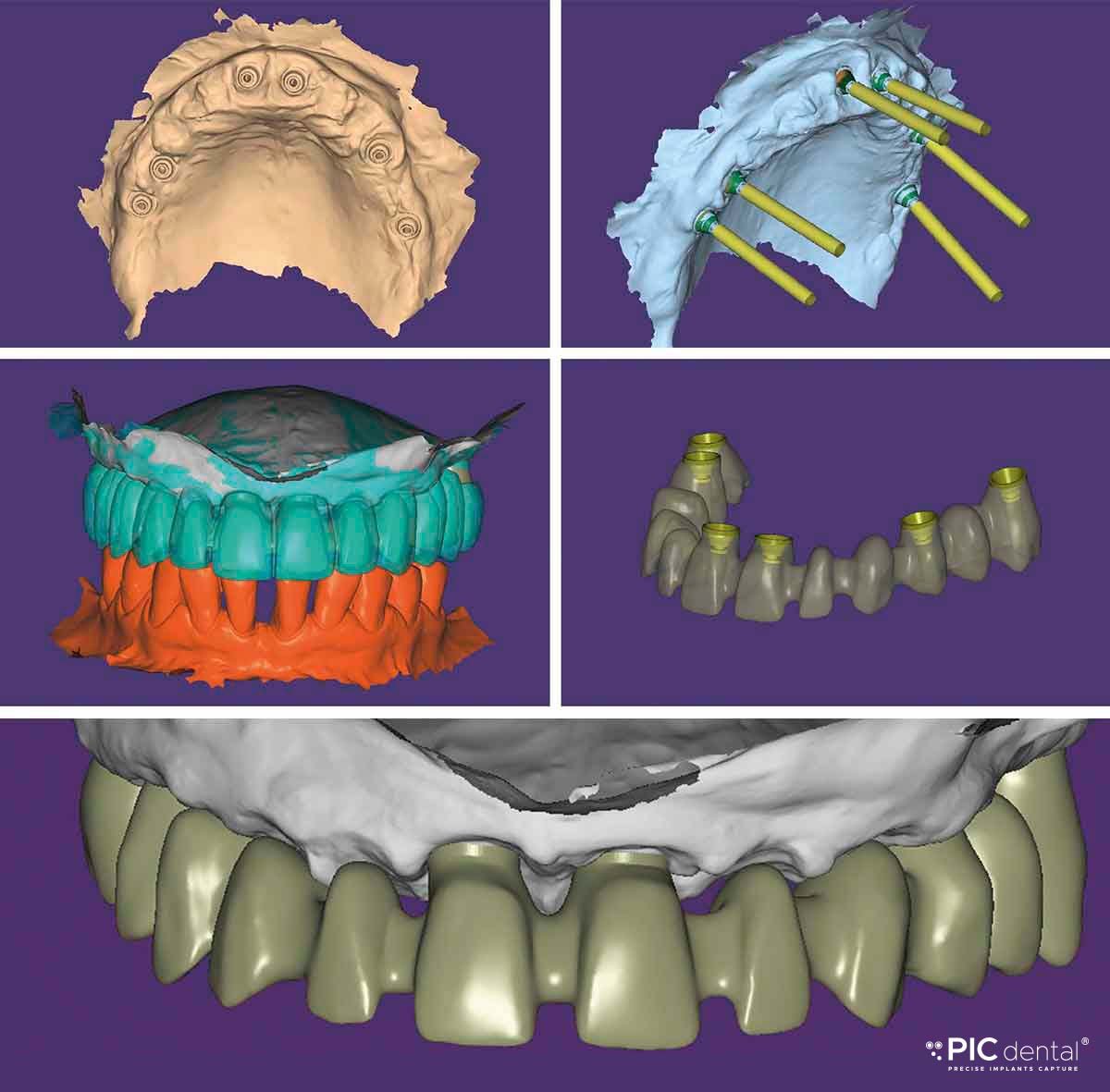 Rehabilitación de una enfermedad periodontal avanzada con una prótesis ...