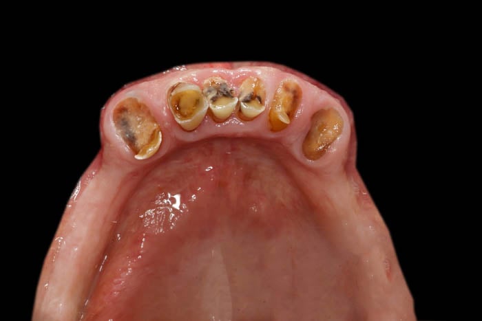 All-On-6 immediate loading with the PIC system