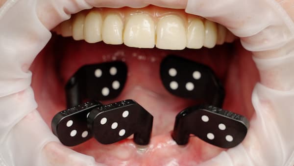 PIC dental